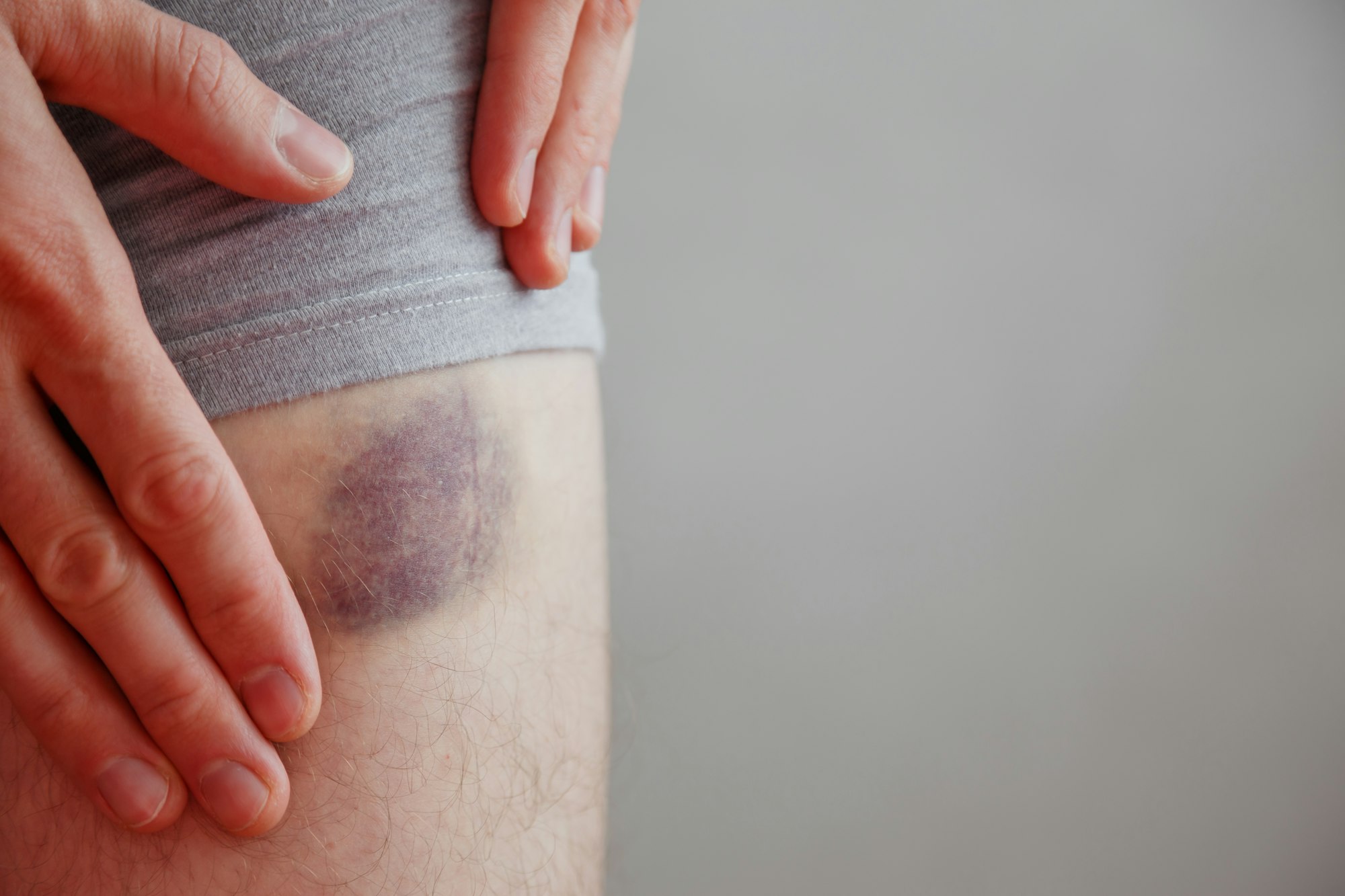 Soft Tissue Injuries - North Charleston Injury Treatment